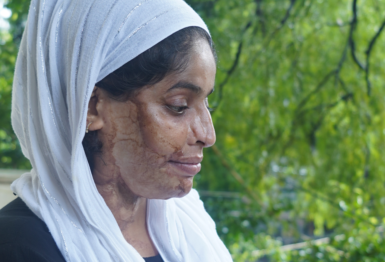 Acid attacks: a cruel war against women in India